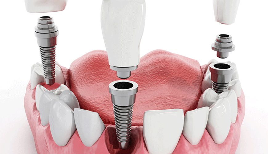 ISO 14801 Dentisterie - Implants - Norme de test de charge dynamique ...